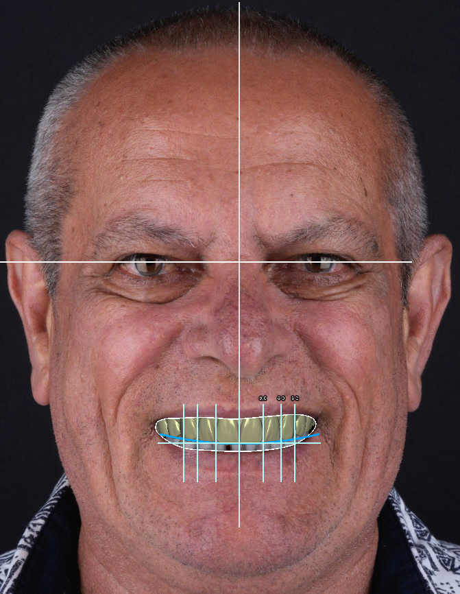 Digital Smile Design (DSD) 2D/3D - Smile Design (DSD) - Design Services ...